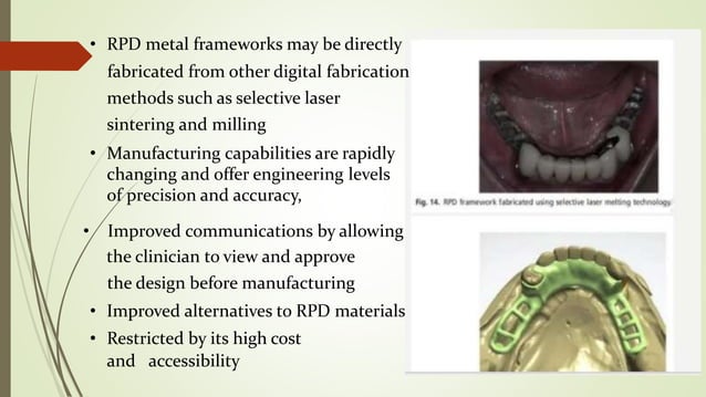 Recent advances in rpd and it's uses in prosthodontics | PPTX