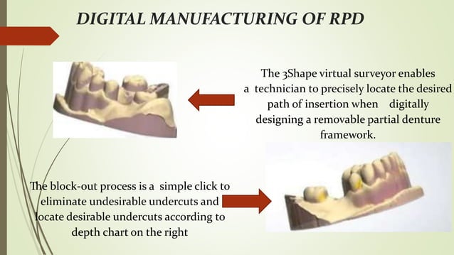 Recent advances in rpd and it's uses in prosthodontics | PPTX