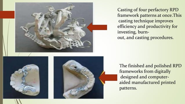 Recent advances in rpd and it's uses in prosthodontics | PPTX