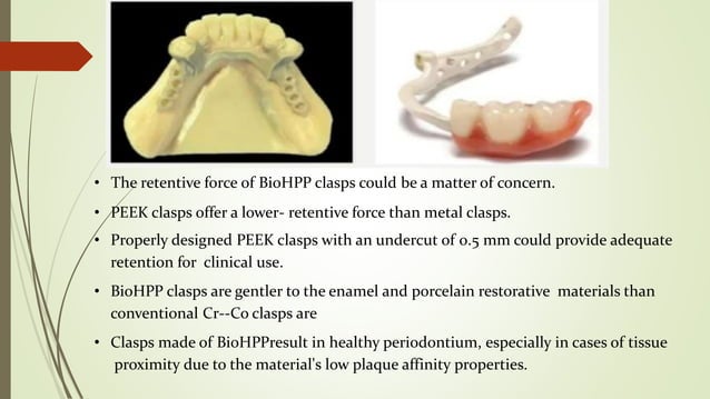 Recent advances in rpd and it's uses in prosthodontics | PPTX