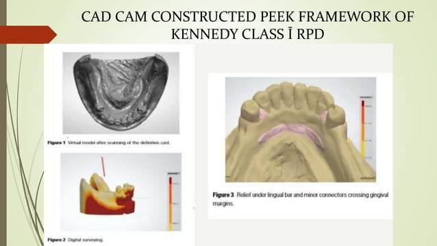 Recent advances in rpd and it's uses in prosthodontics | PPTX