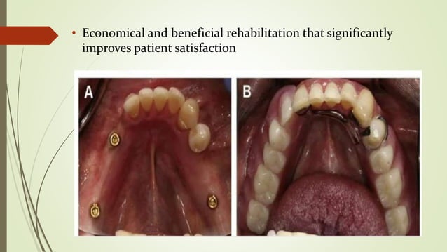 Recent advances in rpd and it's uses in prosthodontics | PPTX