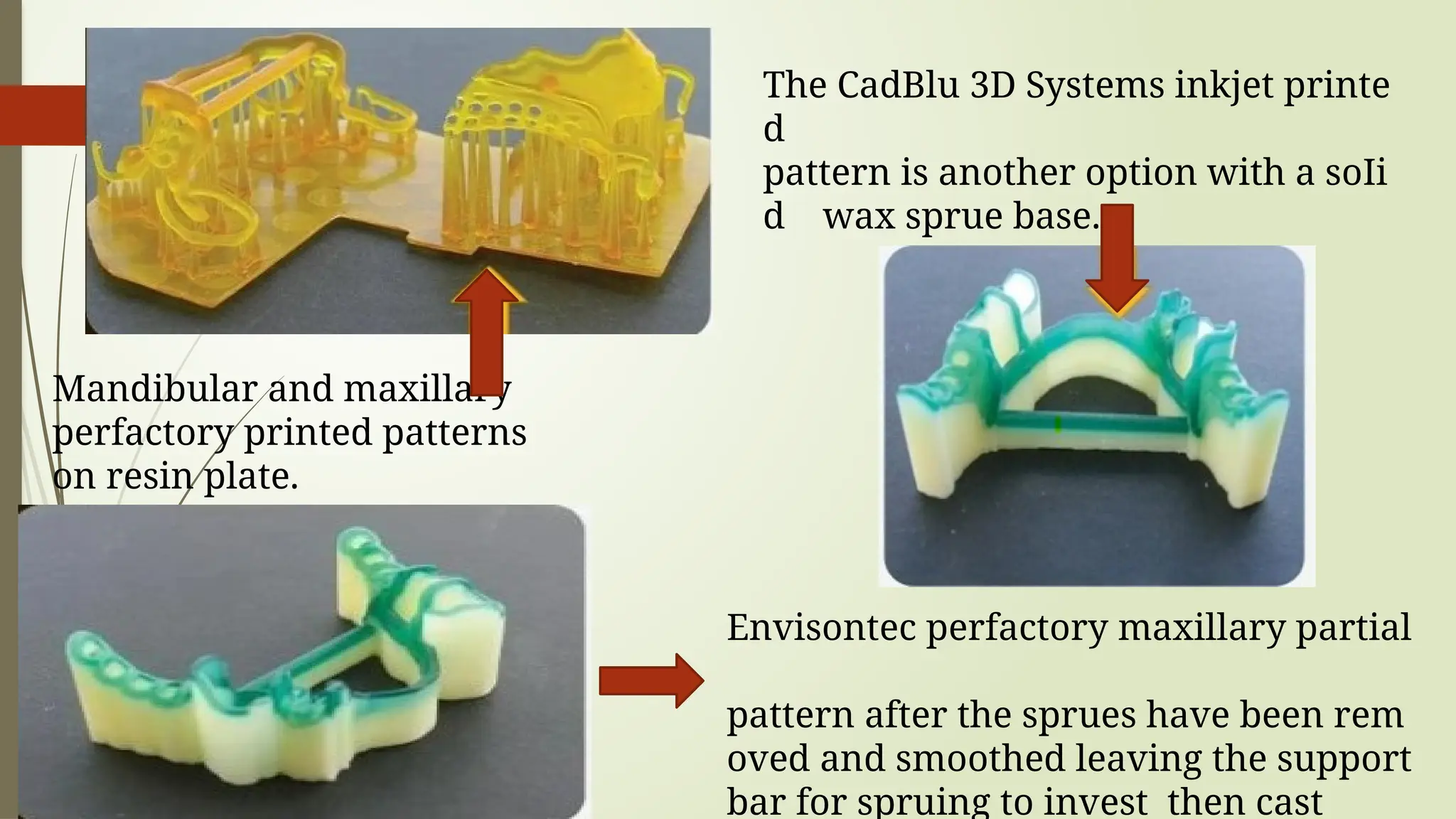 SEMINAR recent advances in Removable partial denture | PPTX