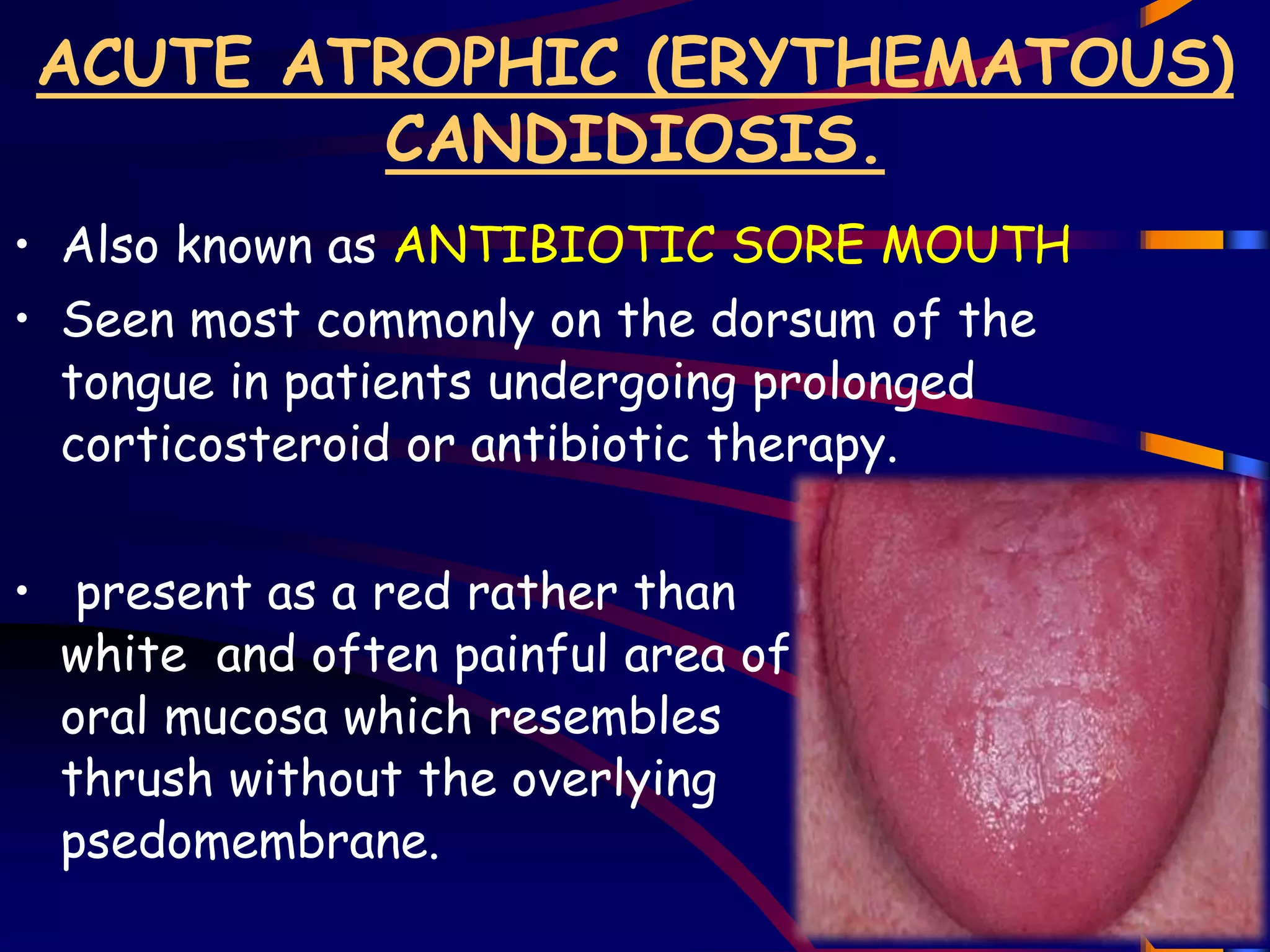 Oral mycotic infections | PPTX