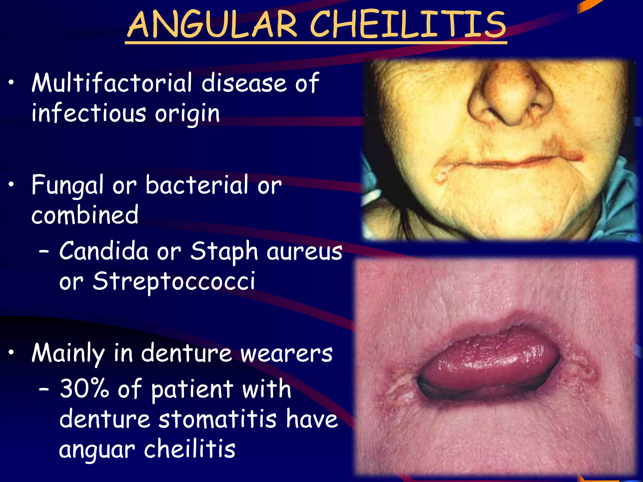 Oral mycotic infections | PPTX