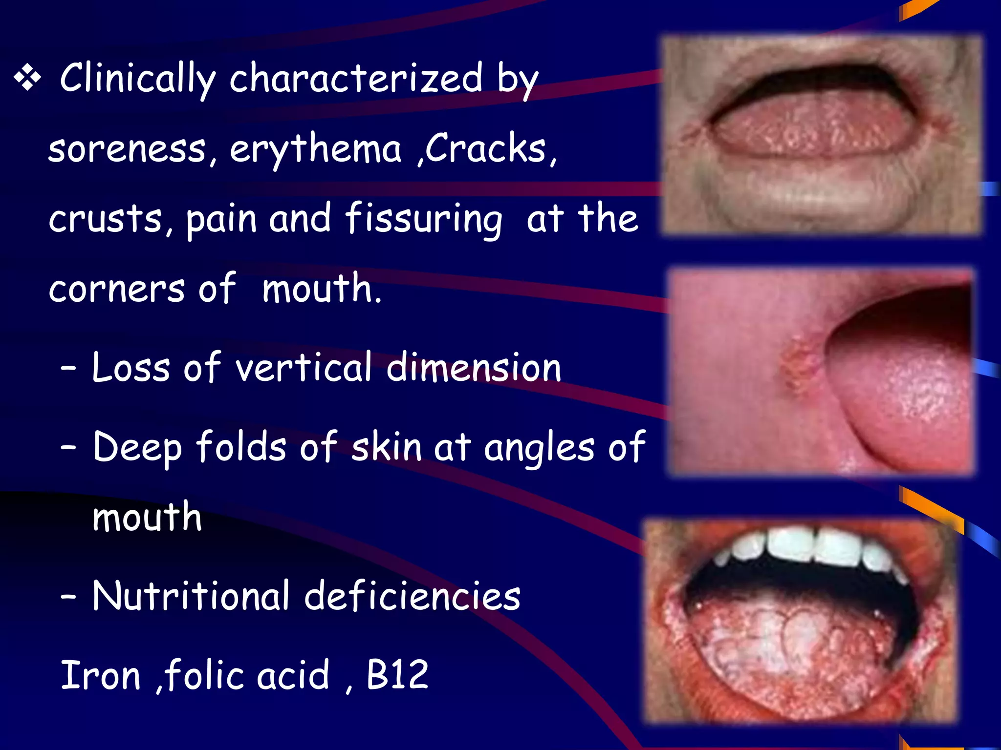 Oral mycotic infections | PPTX