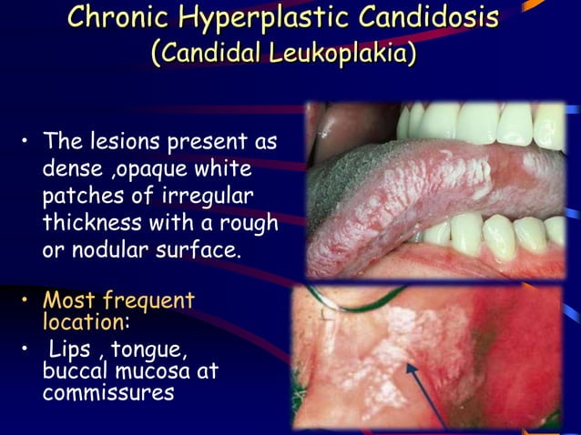 Oral mycotic infections | PPTX