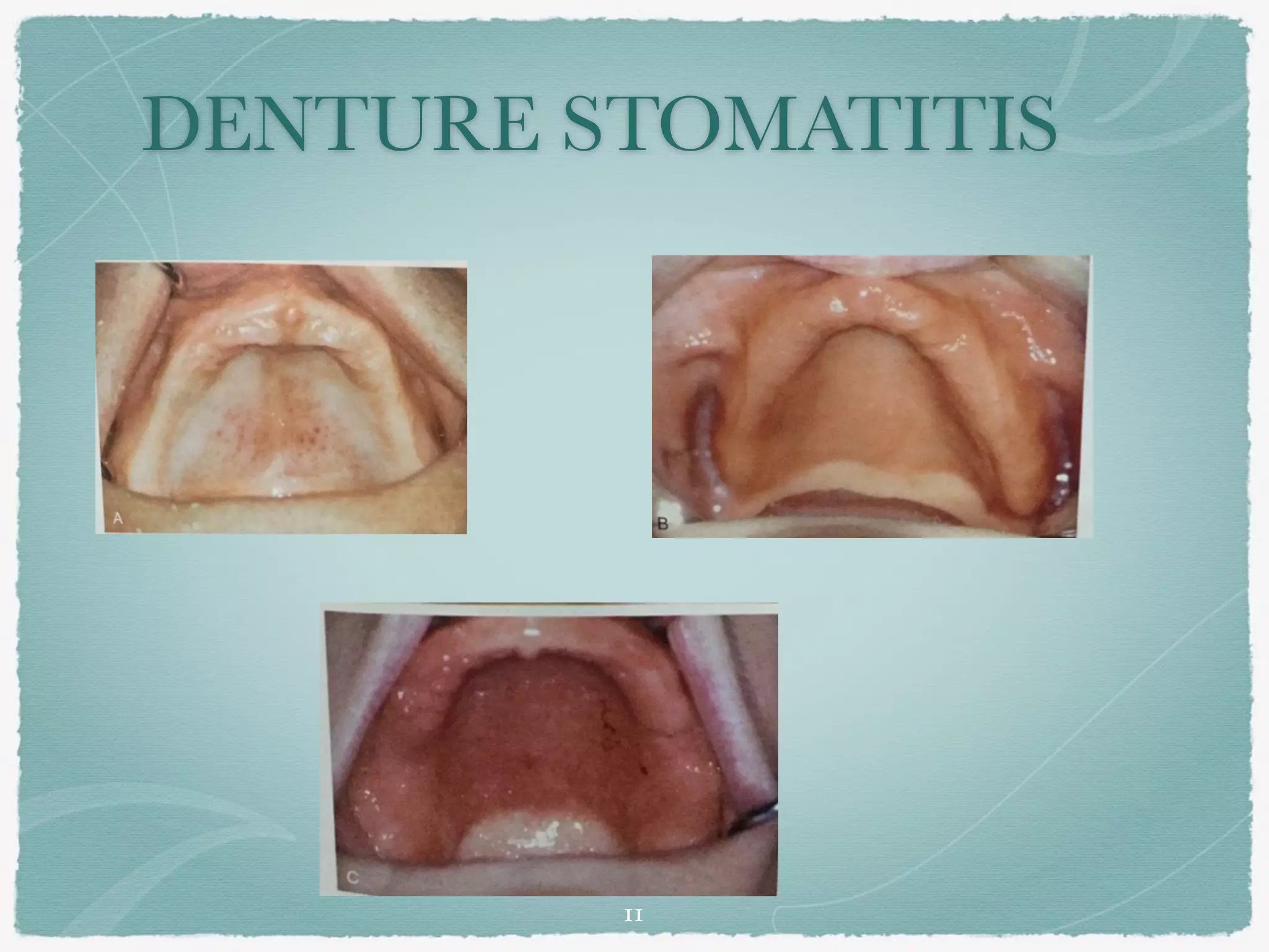Sequelae caused by wearing dentures | PDF