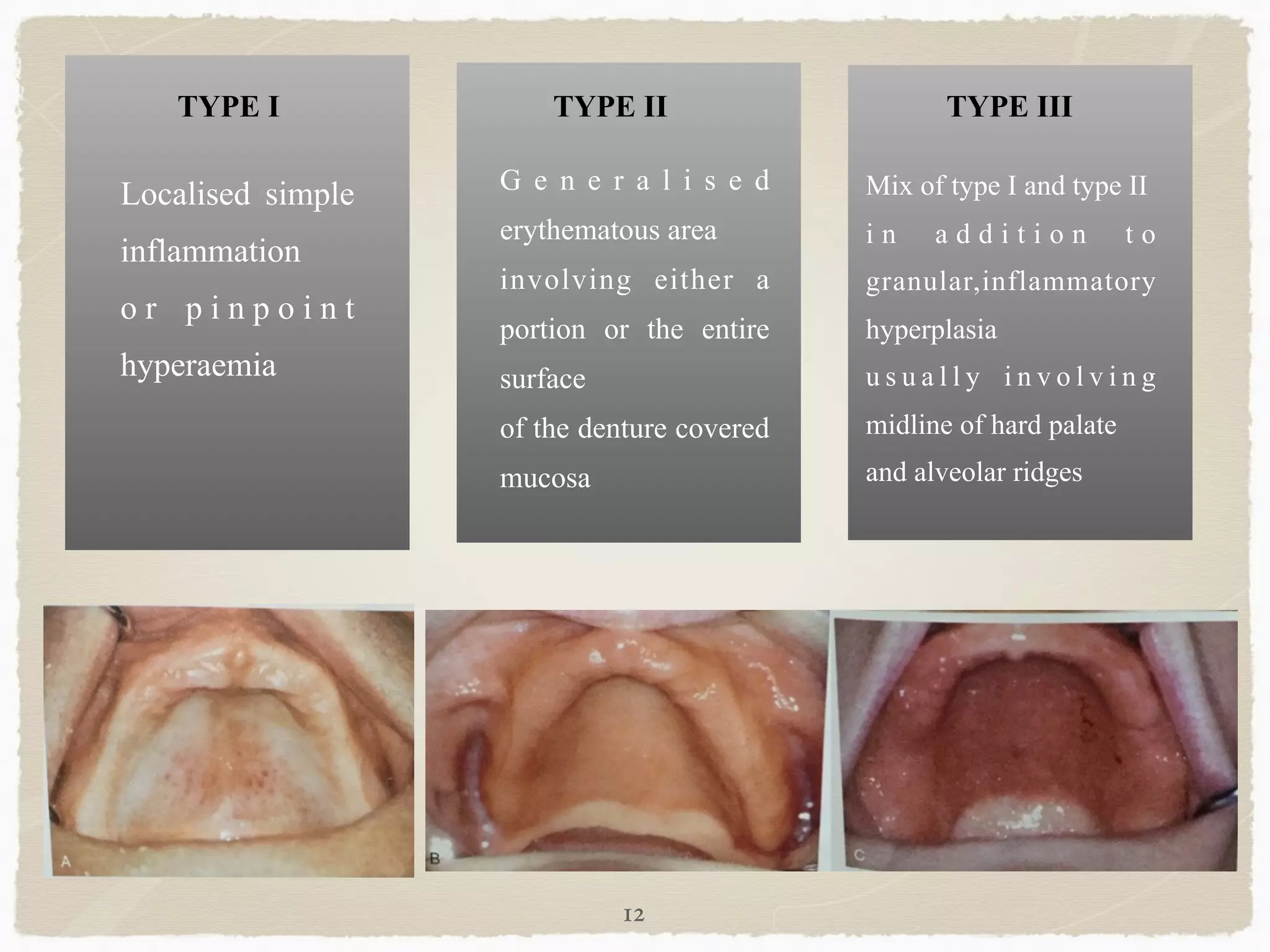 Sequelae caused by wearing dentures | PDF