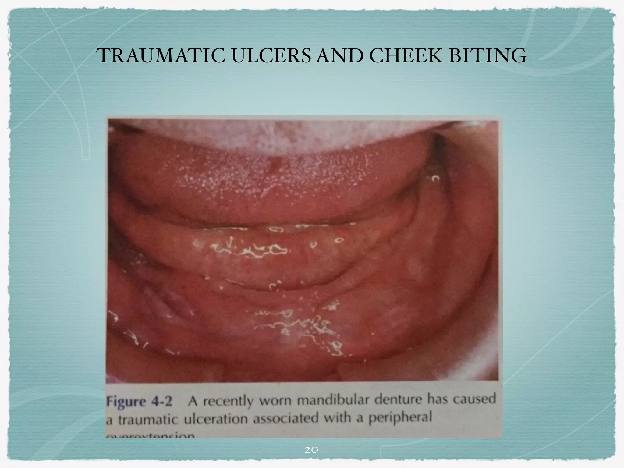 Sequelae caused by wearing dentures | PDF