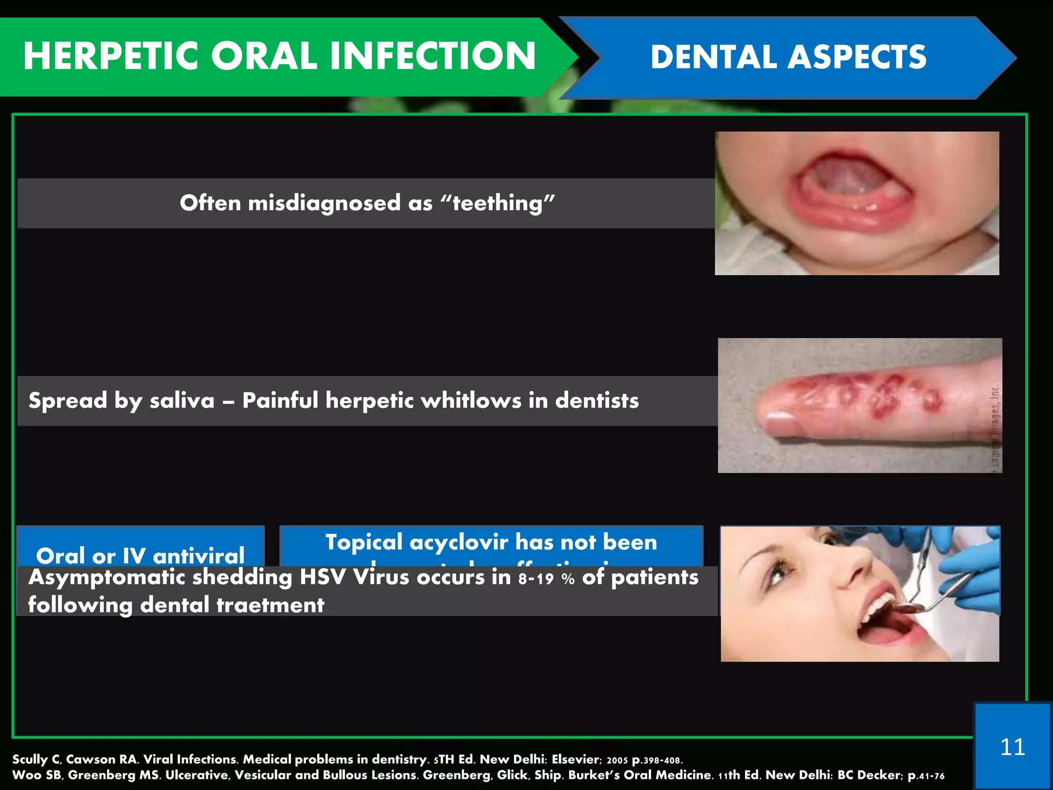 Fungal & Viral Infections Of The Oral Cavity, FUNGAL INFECTIONS, VIRAL ...