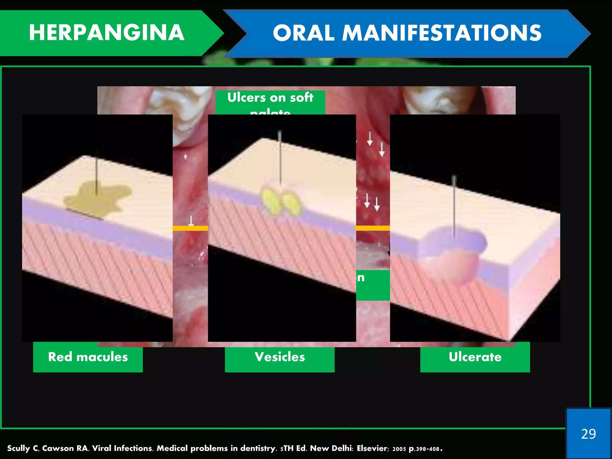 Fungal & Viral Infections Of The Oral Cavity, FUNGAL INFECTIONS, VIRAL ...