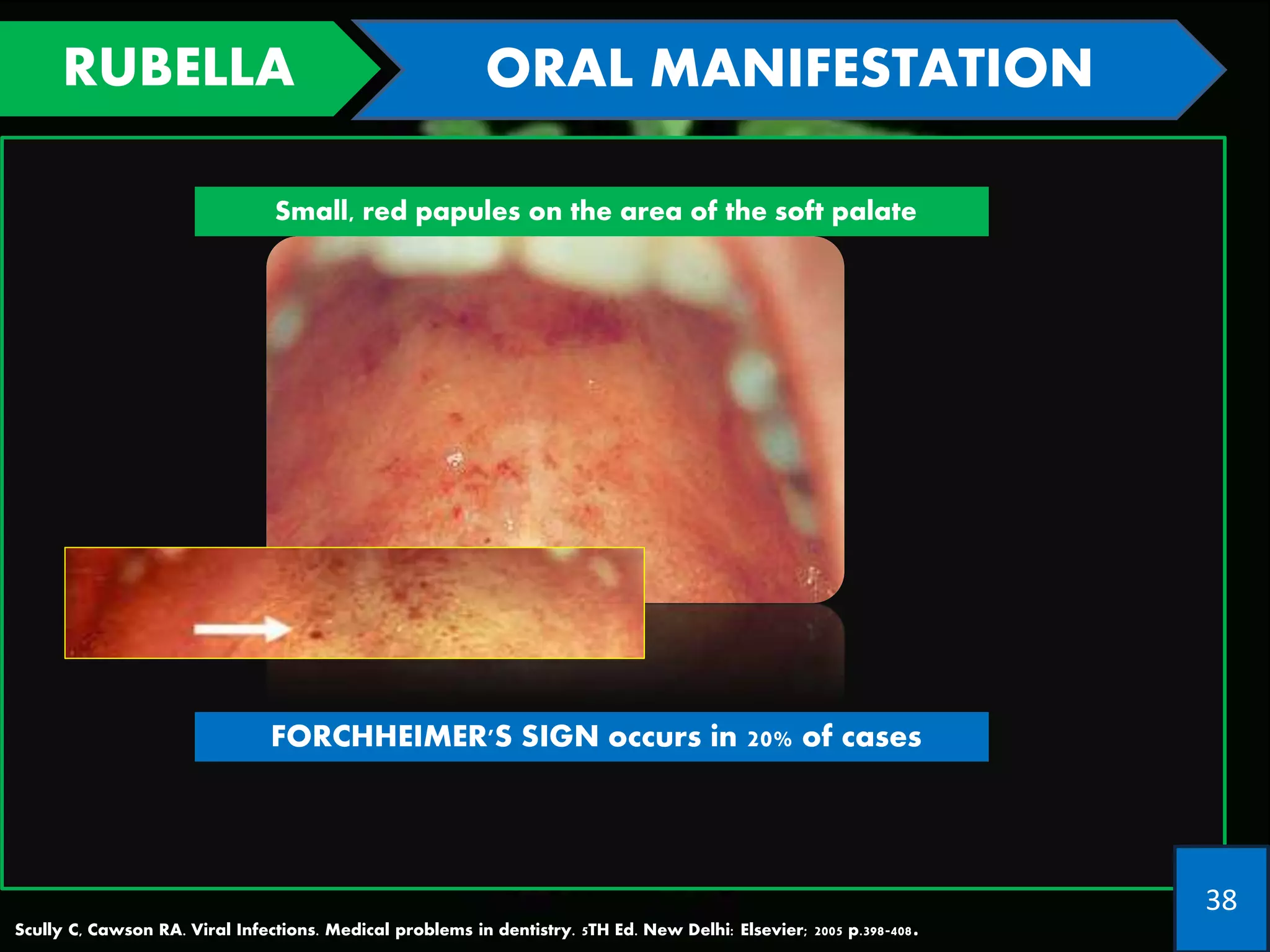 Fungal & Viral Infections Of The Oral Cavity, FUNGAL INFECTIONS, VIRAL ...