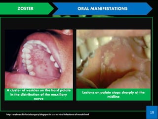 Fungal & Viral Infections Of The Oral Cavity, FUNGAL INFECTIONS, VIRAL ...