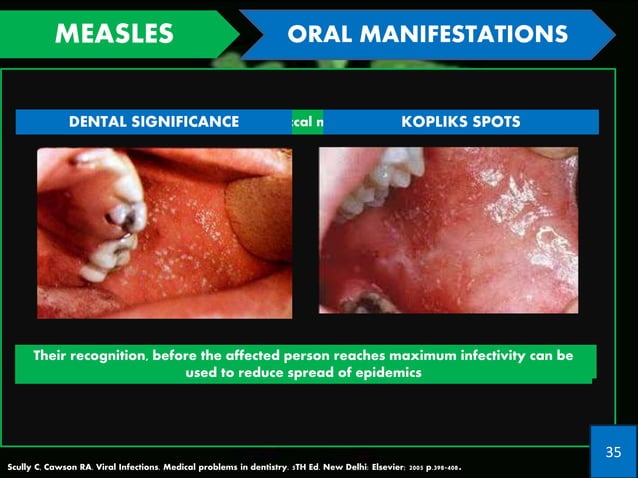Fungal & Viral Infections Of The Oral Cavity, FUNGAL INFECTIONS, VIRAL ...