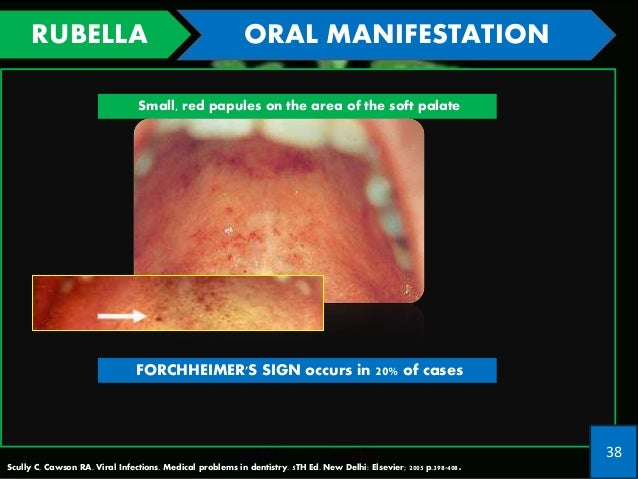 Fungal & Viral Infections Of The Oral Cavity, FUNGAL INFECTIONS, VIR…