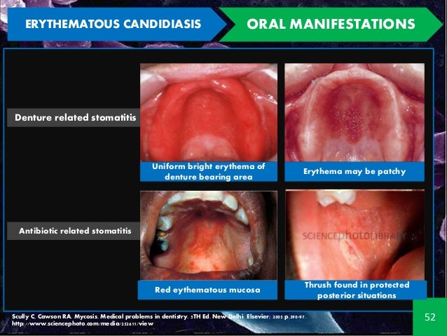 Fungal & Viral Infections Of The Oral Cavity, FUNGAL INFECTIONS, VIR…