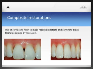 ROOT COVERAGE PROCEDURES | PPTX