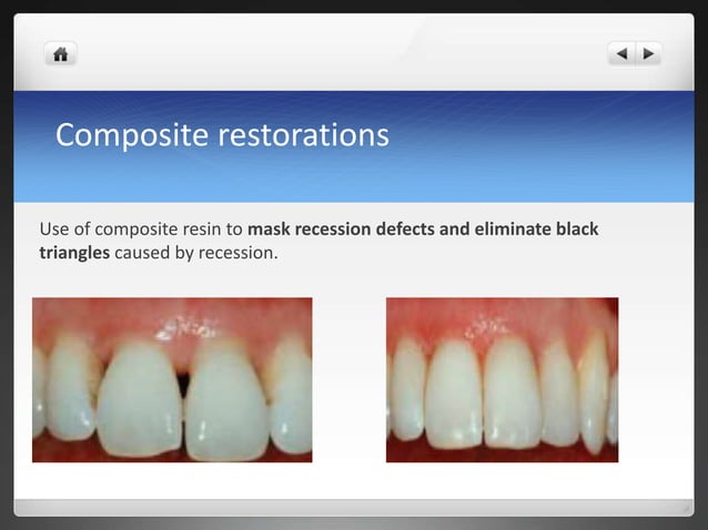 ROOT COVERAGE PROCEDURES | PPTX