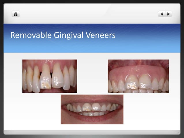 ROOT COVERAGE PROCEDURES | PPTX