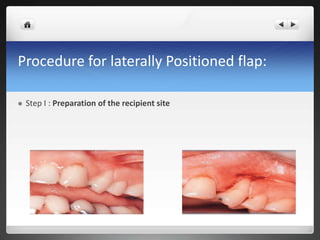 ROOT COVERAGE PROCEDURES | PPTX