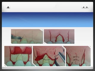 ROOT COVERAGE PROCEDURES | PPTX
