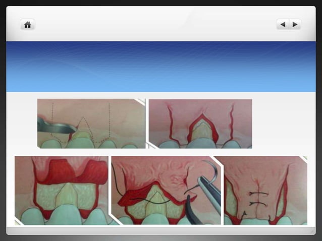ROOT COVERAGE PROCEDURES | PPTX