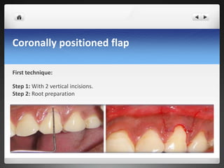 ROOT COVERAGE PROCEDURES | PPTX