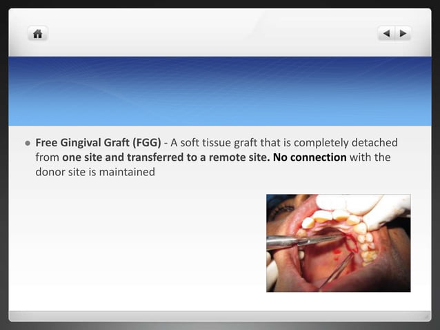 ROOT COVERAGE PROCEDURES | PPTX