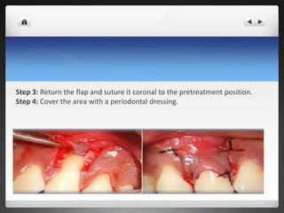 ROOT COVERAGE PROCEDURES | PPTX