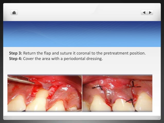 ROOT COVERAGE PROCEDURES | PPTX