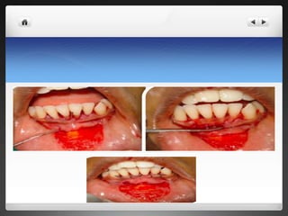 ROOT COVERAGE PROCEDURES | PPTX