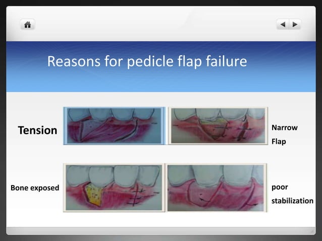 ROOT COVERAGE PROCEDURES | PPTX