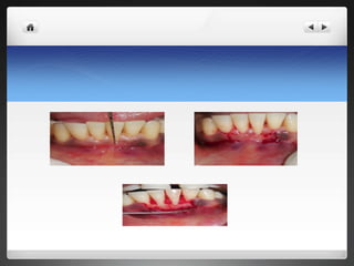 ROOT COVERAGE PROCEDURES | PPTX