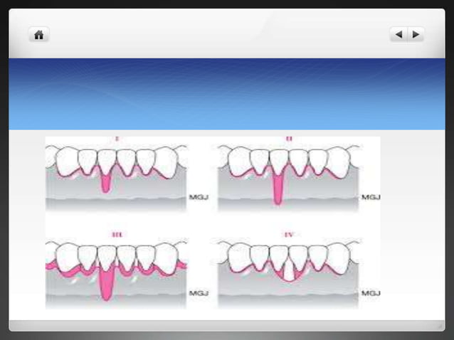 ROOT COVERAGE PROCEDURES | PPTX
