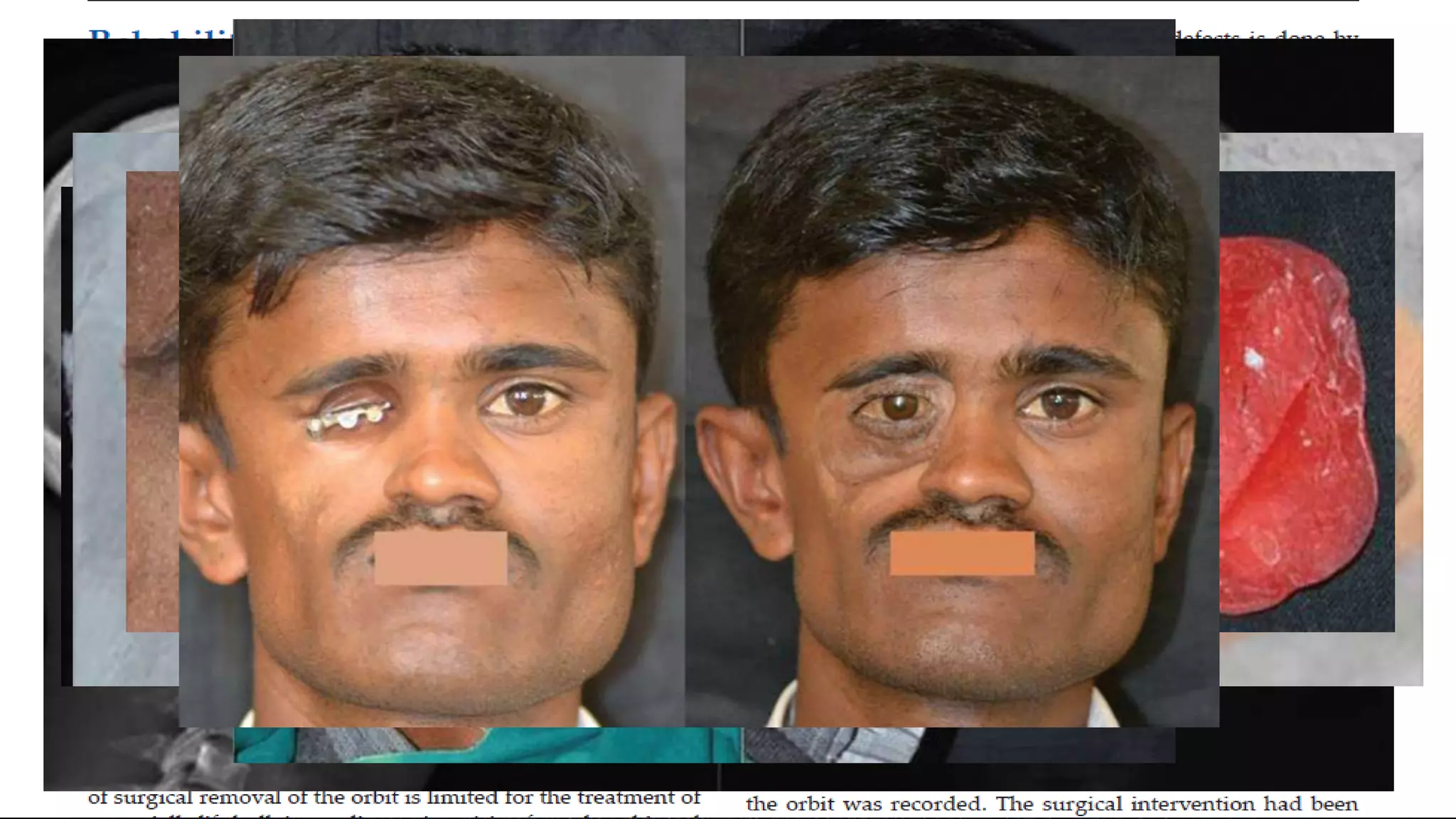 implant retained maxillofacial prosthesis | PPTX