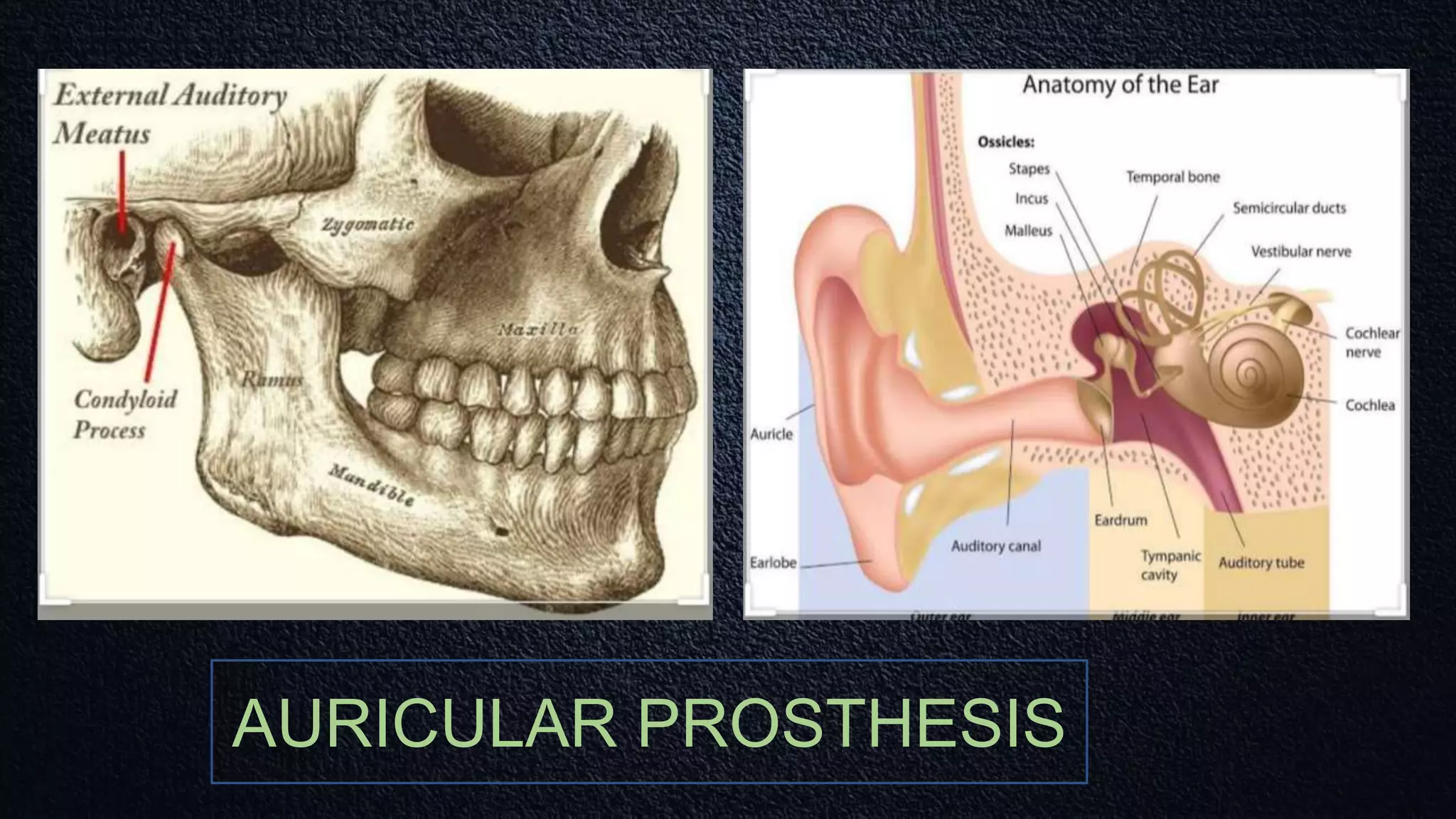implant retained maxillofacial prosthesis | PPTX