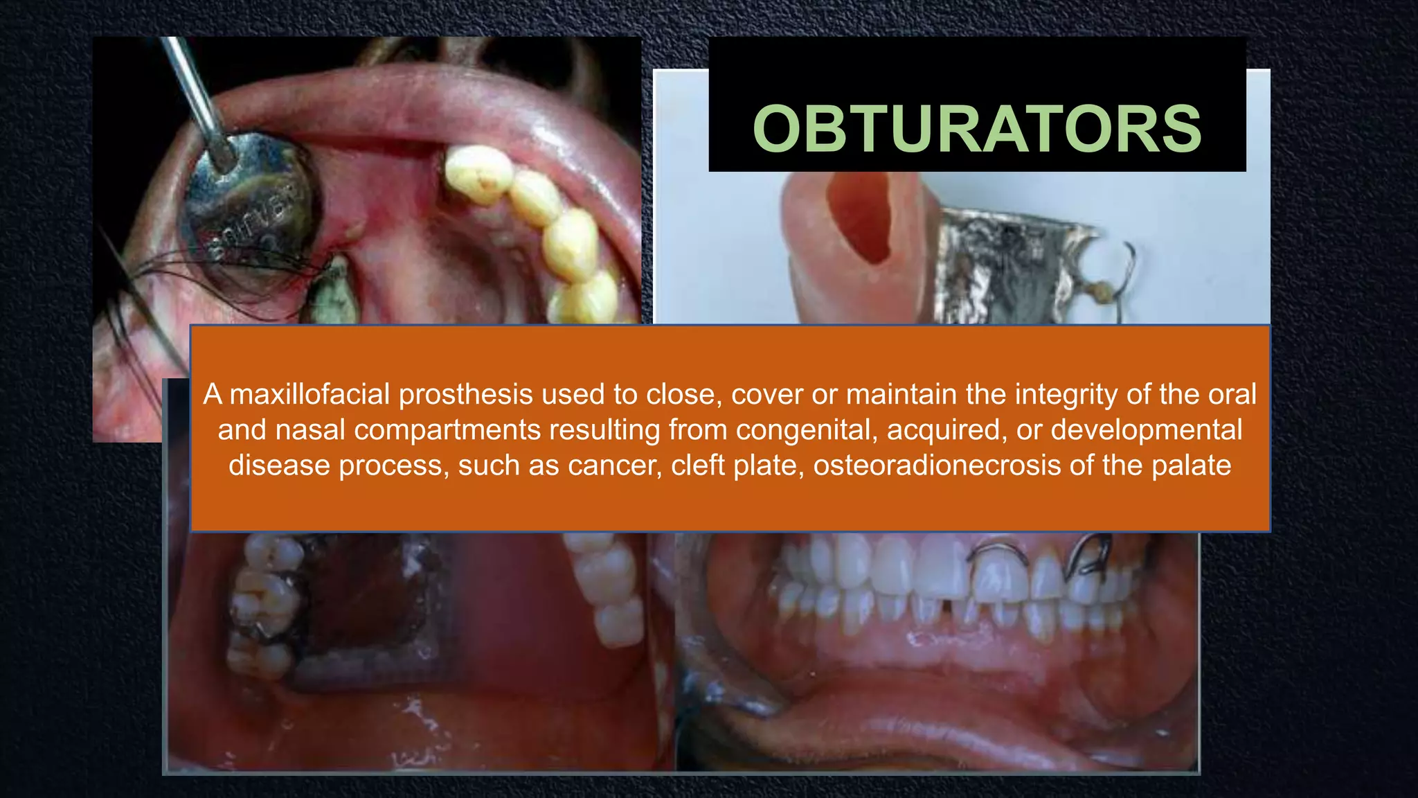 implant retained maxillofacial prosthesis | PPTX