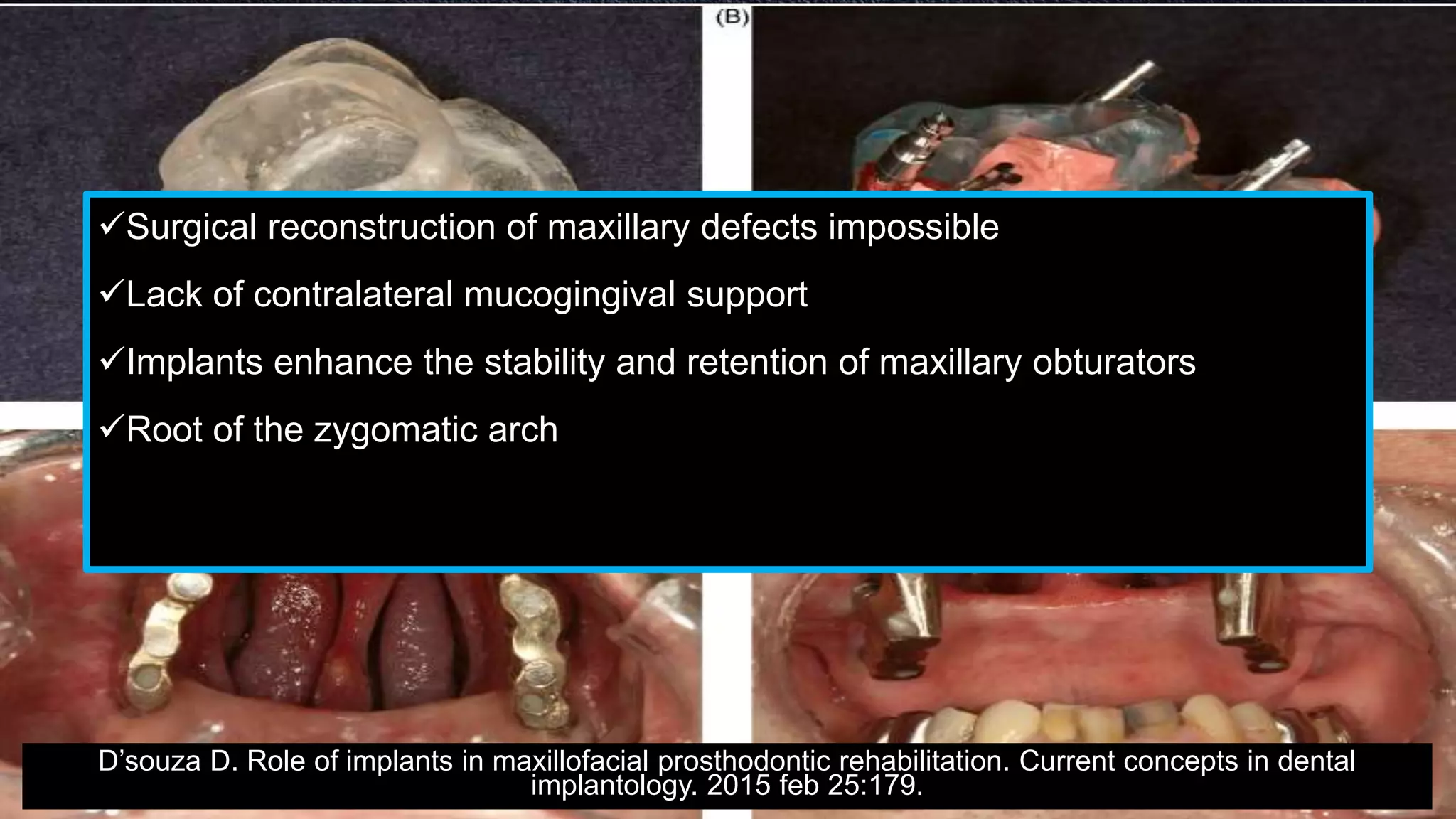 implant retained maxillofacial prosthesis | PPTX
