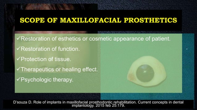 implant retained maxillofacial prosthesis | PPTX | Ear, Nose and Throat ...