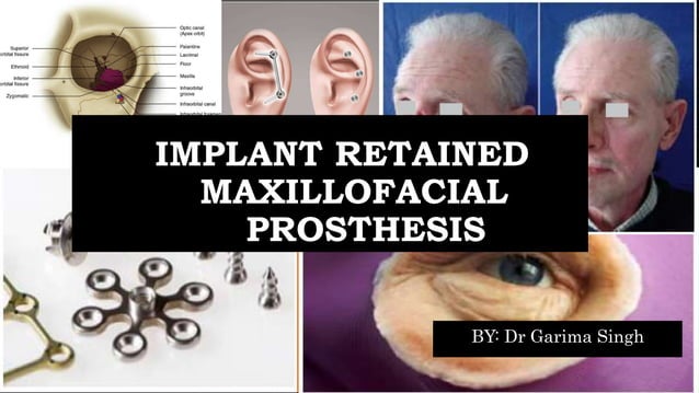 implant retained maxillofacial prosthesis | PPTX | Ear, Nose and Throat ...