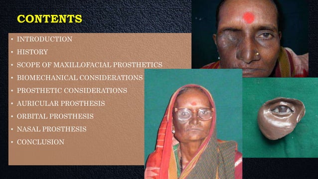 implant retained maxillofacial prosthesis | PPTX | Ear, Nose and Throat ...