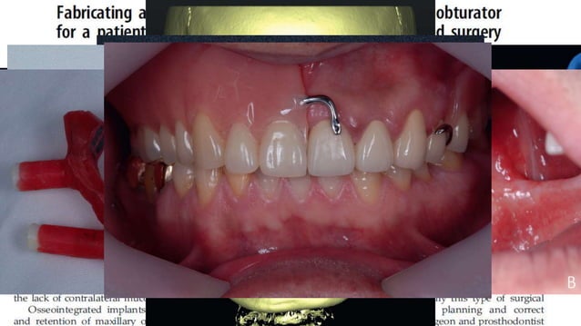 implant retained maxillofacial prosthesis | PPTX | Ear, Nose and Throat ...
