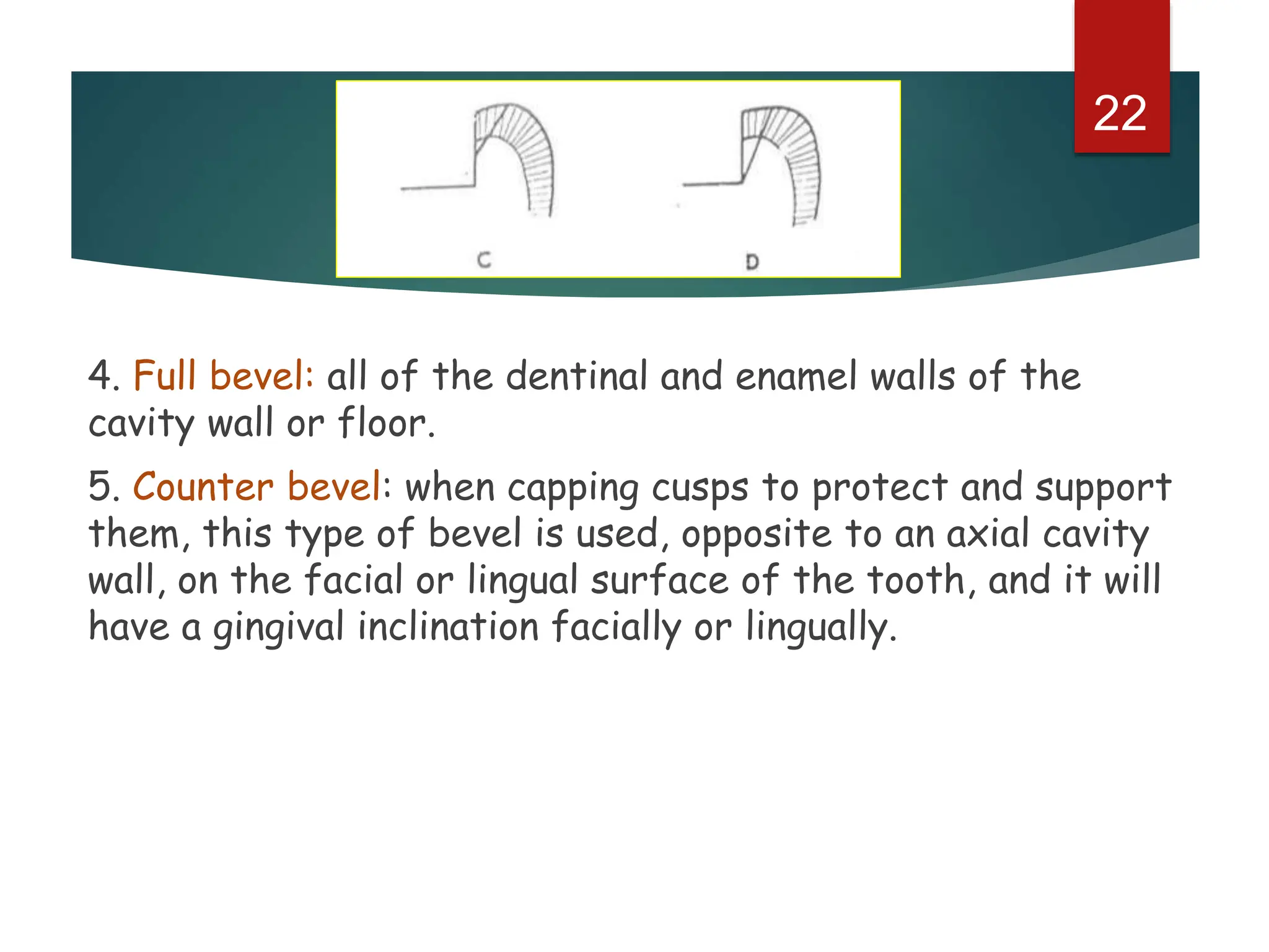 SEMINAR -inlay cavity designs | PPTX