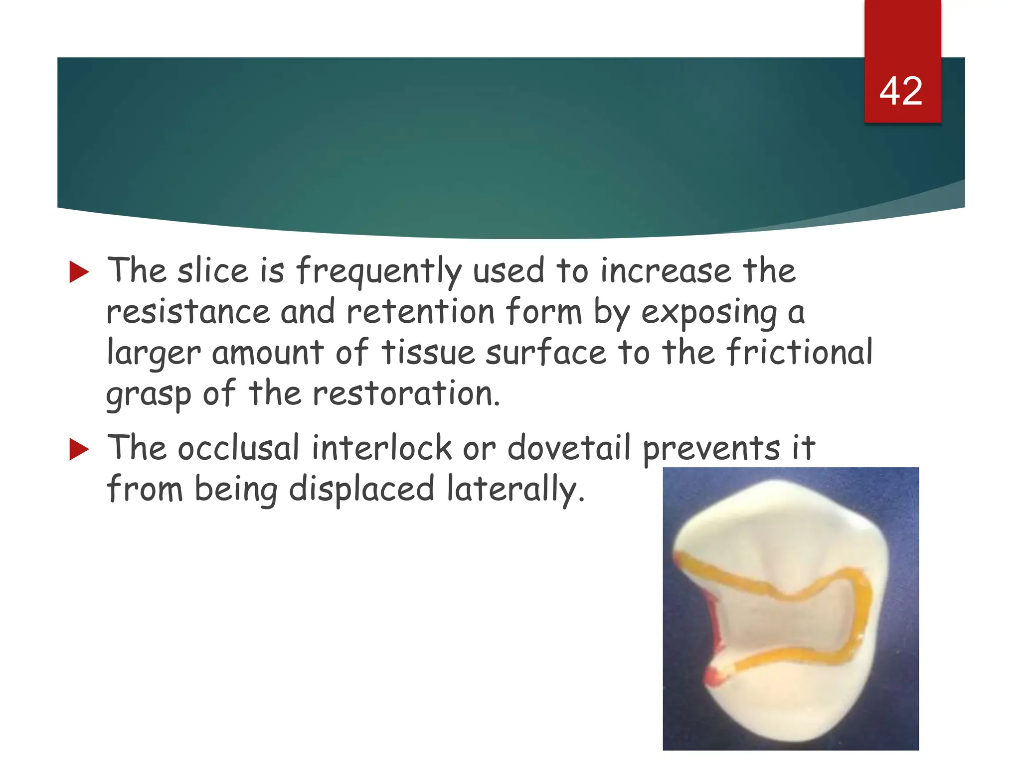 SEMINAR -inlay cavity designs | PPTX