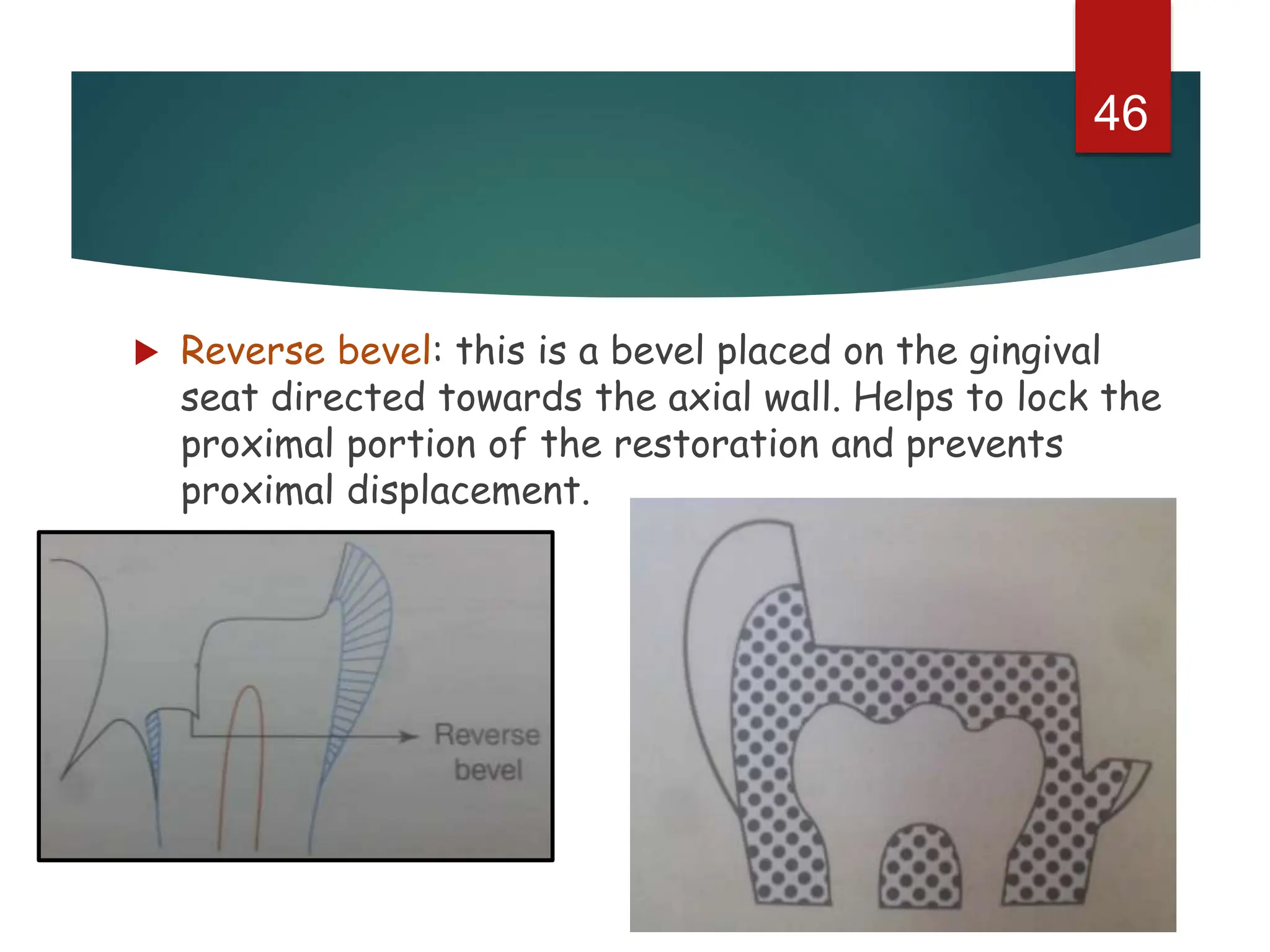 SEMINAR -inlay cavity designs | PPTX