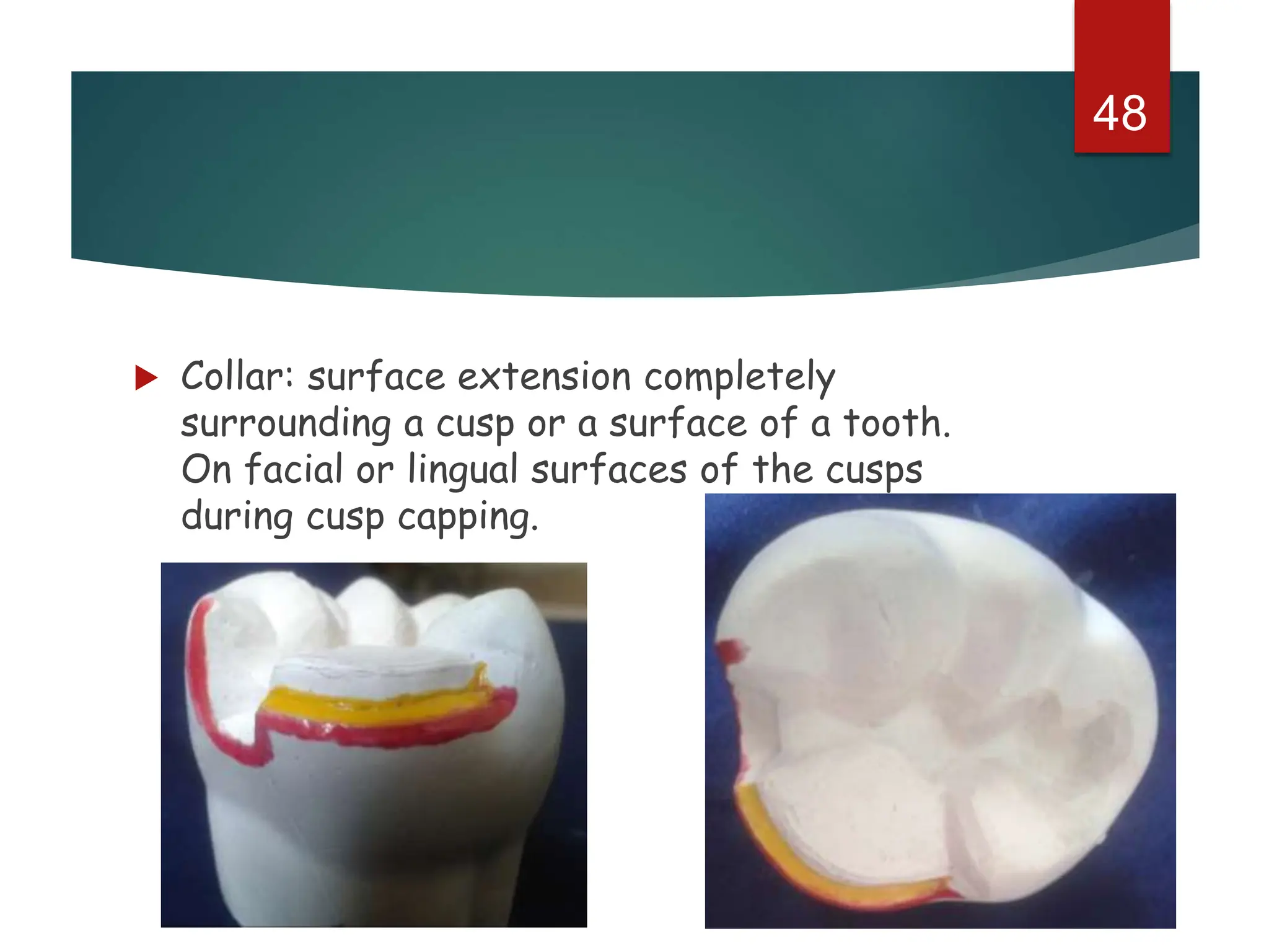 SEMINAR -inlay cavity designs | PPTX