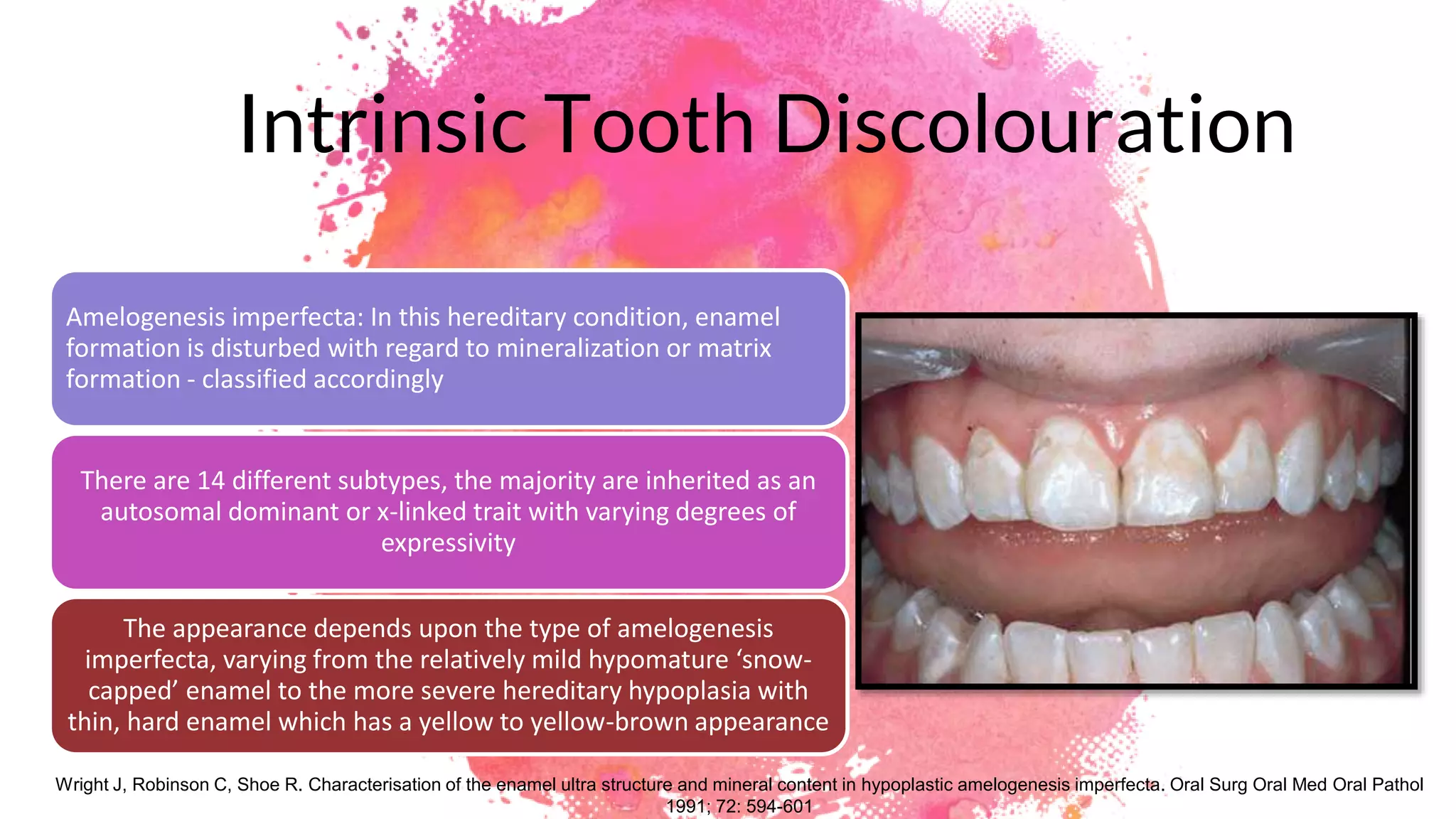 Intrinsic and Extrinsic Discoloration | PPTX
