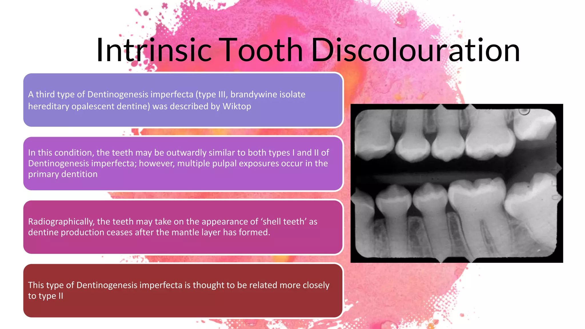 Intrinsic and Extrinsic Discoloration | PPTX
