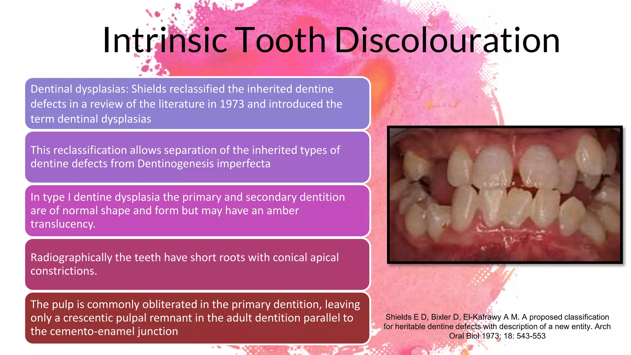 Intrinsic and Extrinsic Discoloration | PPTX
